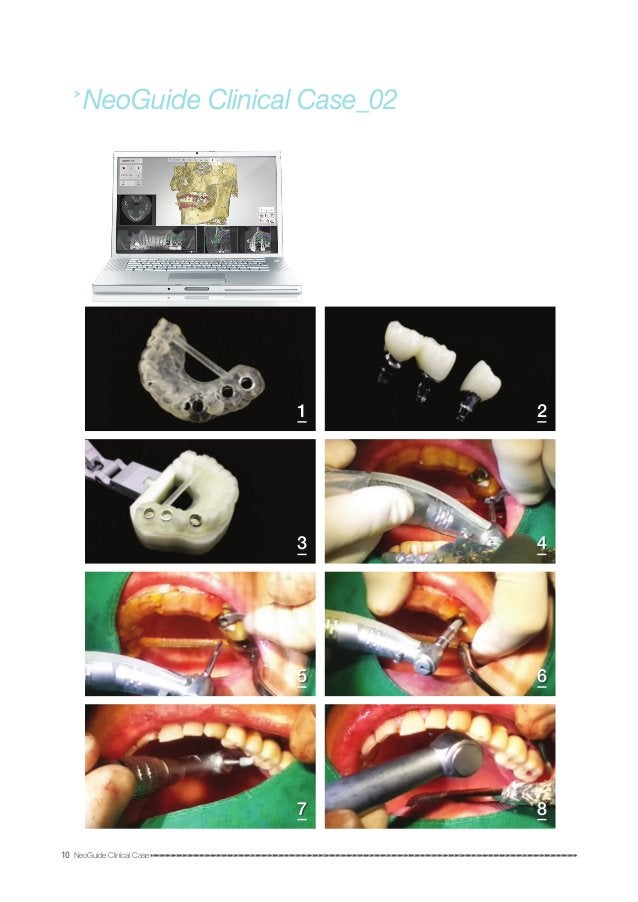 Neo guide system_201505_ver04 | PDF | Dental Health | Diseases and ...