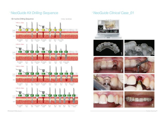 Neo guide system_201505_ver04 | PDF | Dental Health | Diseases and ...