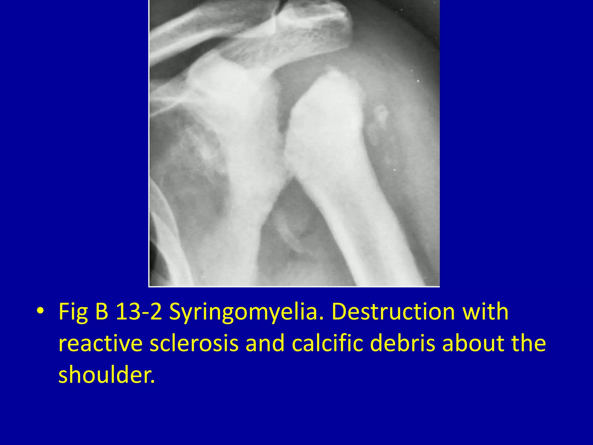 13 neuroarthropathy (charcot joint) | PPTX