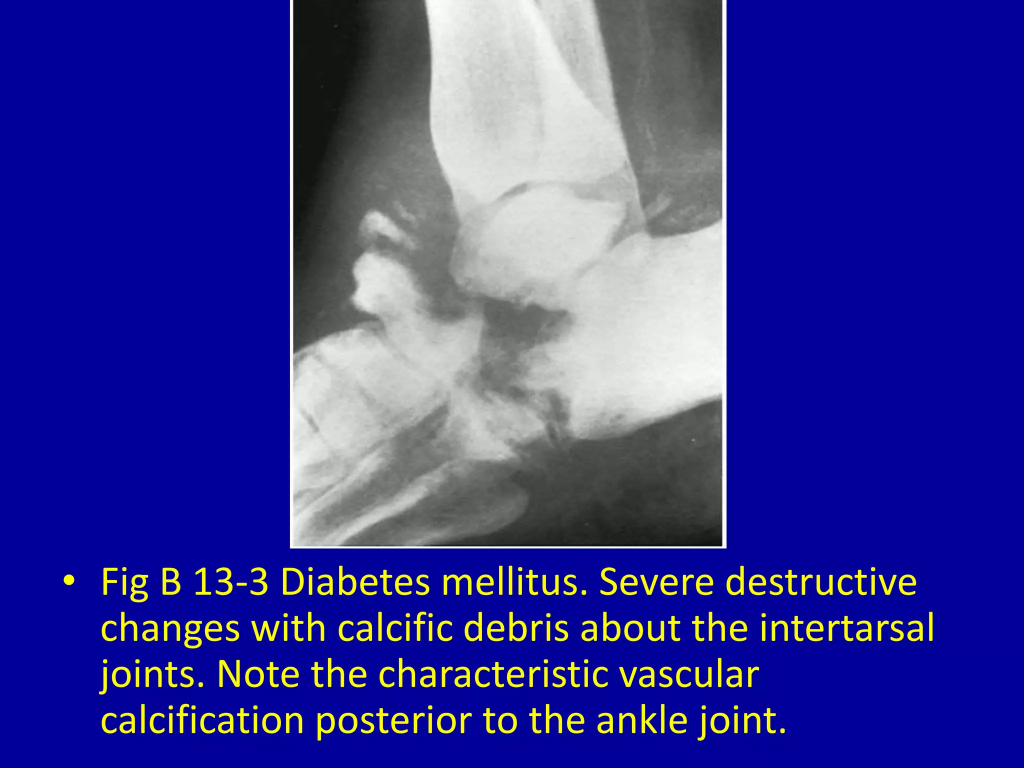 13 neuroarthropathy (charcot joint) | PPTX
