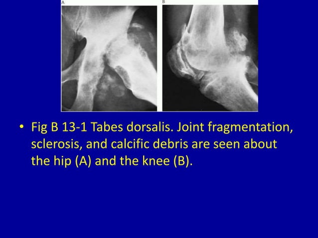 13 neuroarthropathy (charcot joint) | PPTX