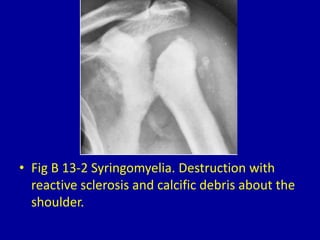 13 neuroarthropathy (charcot joint) | PPTX