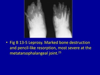 13 neuroarthropathy (charcot joint) | PPTX