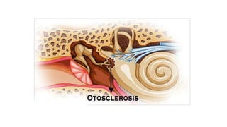 OTOSCLEROSIS | PPTX