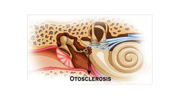 OTOSCLEROSIS | PPTX