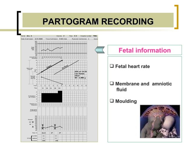 13 partogram | PPT | Pregnancy | Reproductive Health