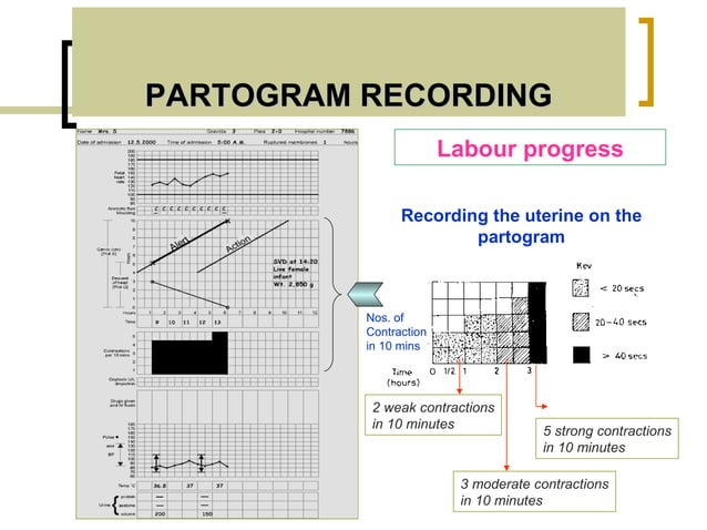 13 partogram | PPT | Pregnancy | Reproductive Health