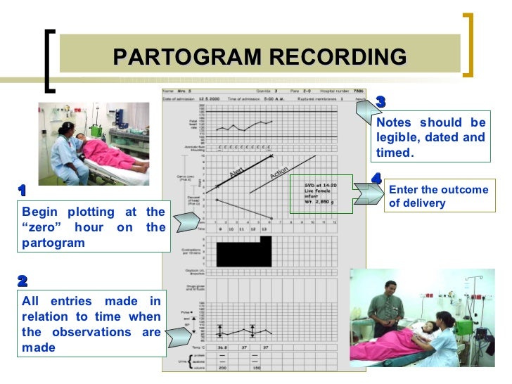 13 partogram