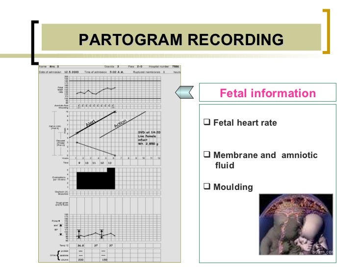 13 partogram