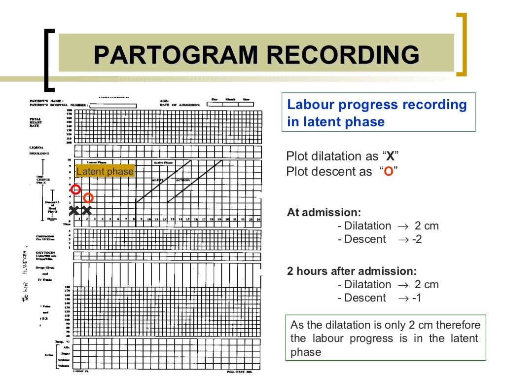 13 partogram