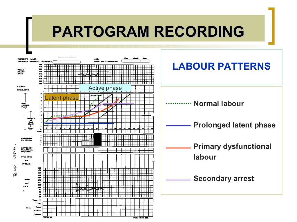 13 partogram