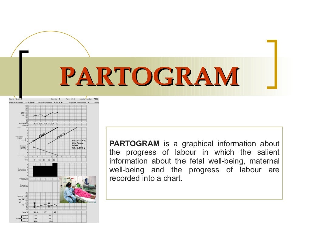13 partogram
