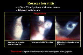 Peripheral Corneal Inflam.ppt