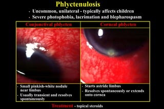Peripheral Corneal Inflam.ppt