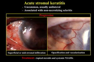 Peripheral Corneal Inflam.ppt
