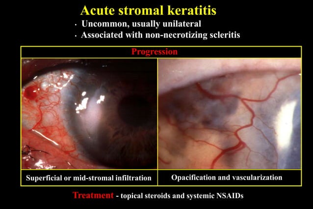 Peripheral Corneal Inflam.ppt