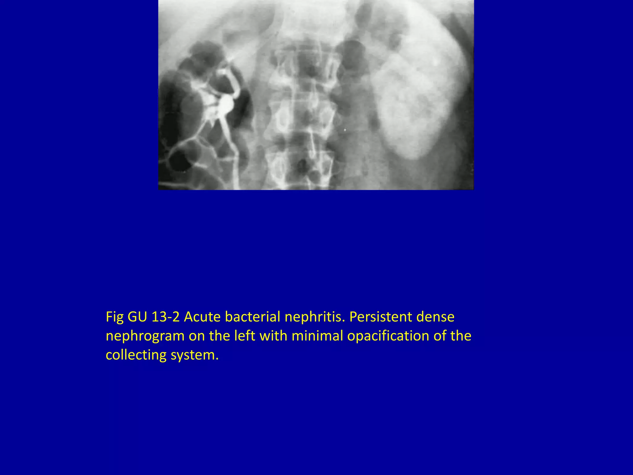 13 persistent or increasingly dense nephrogram | PPTX