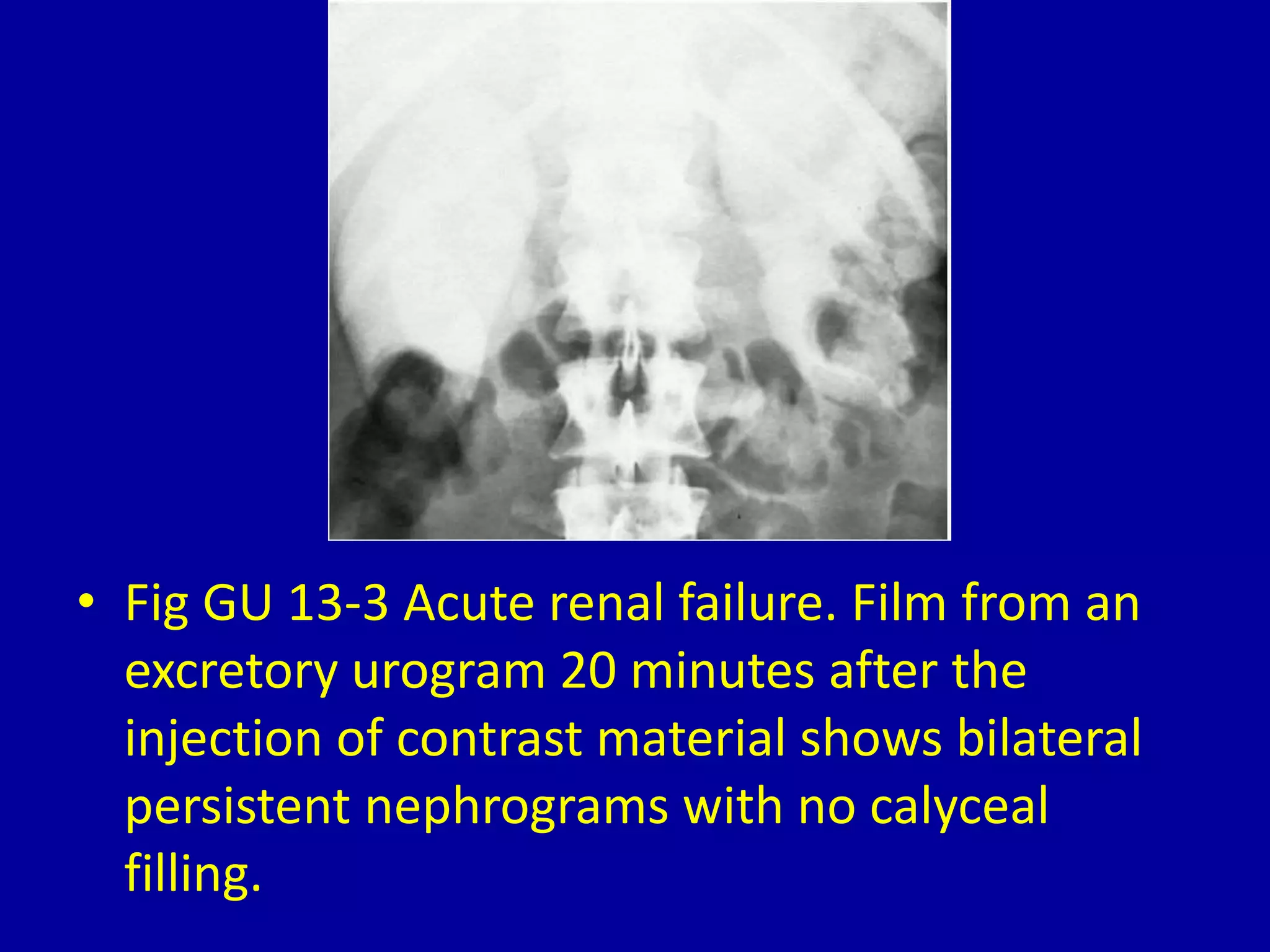 13 persistent or increasingly dense nephrogram | PPTX