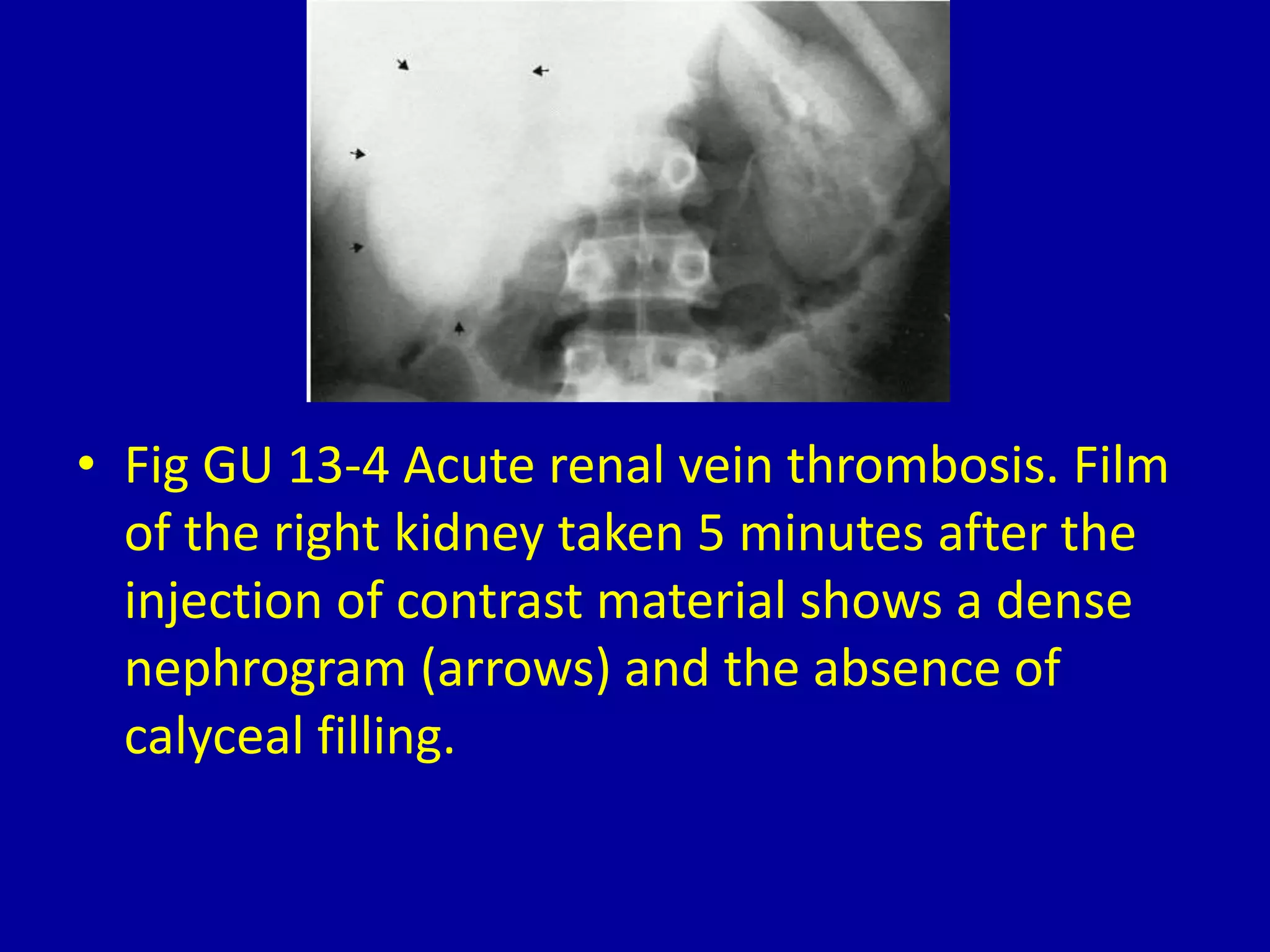 13 persistent or increasingly dense nephrogram | PPTX
