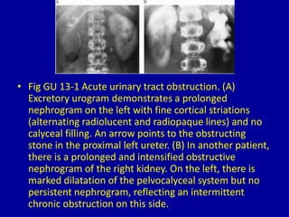 13 persistent or increasingly dense nephrogram | PPT