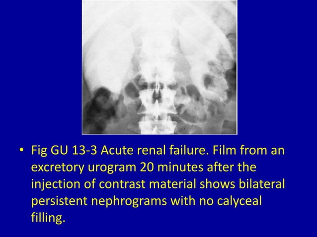 13 persistent or increasingly dense nephrogram | PPTX