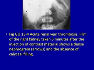 13 persistent or increasingly dense nephrogram | PPTX
