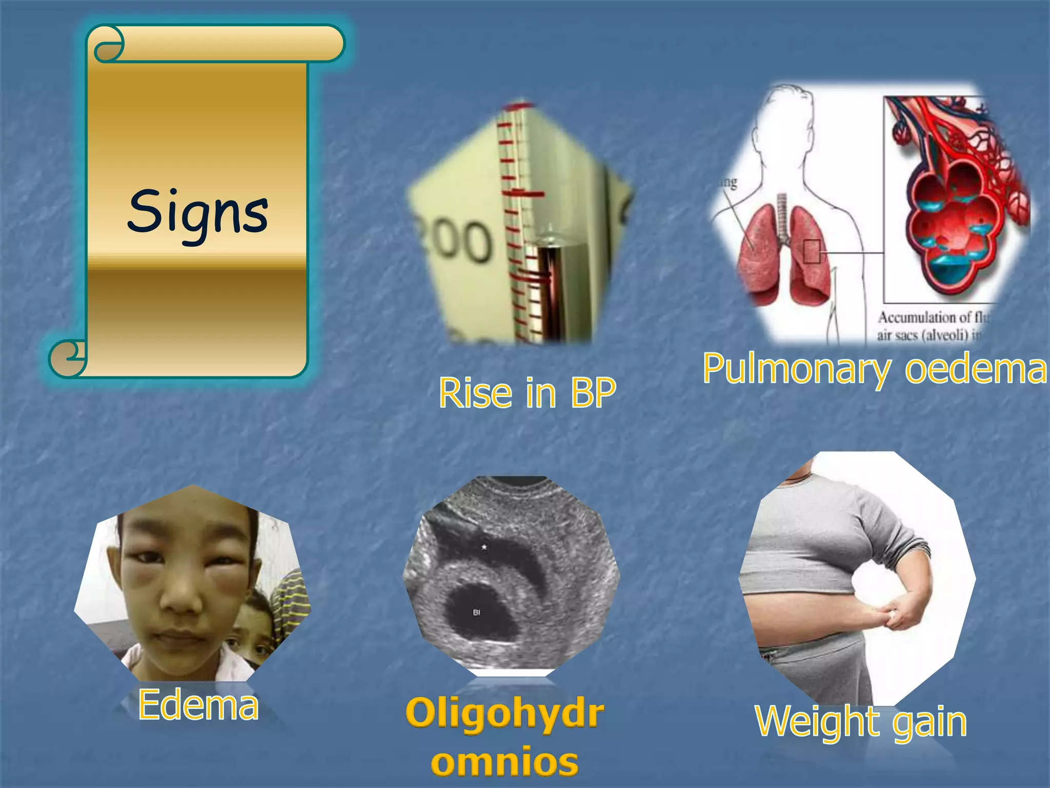 Toxemia of pregnancy: pre-eclampsia | PPTX