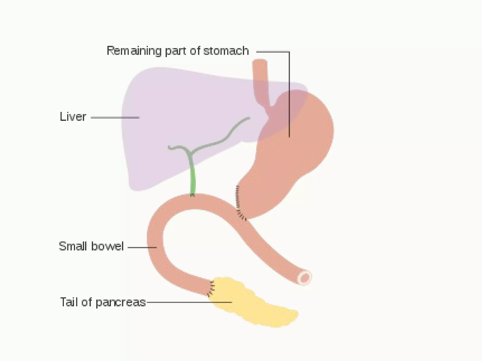 CASE PRESENTATION ON obstructive jaundice | PPT