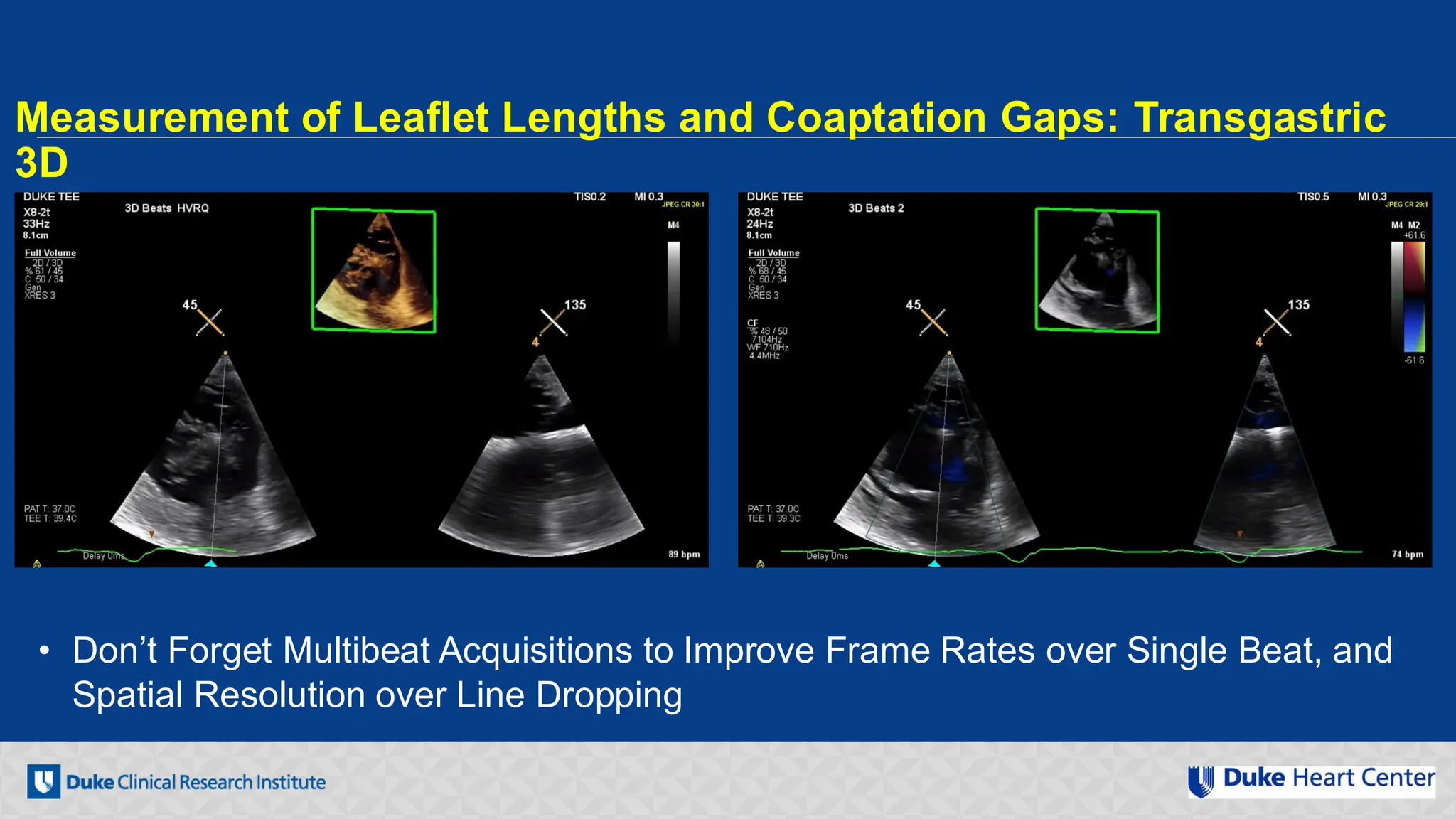 Echocardiography for Structural Heart Disease Interventions | PDF