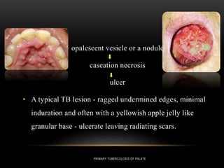 Destructive lesions of palate | PPTX