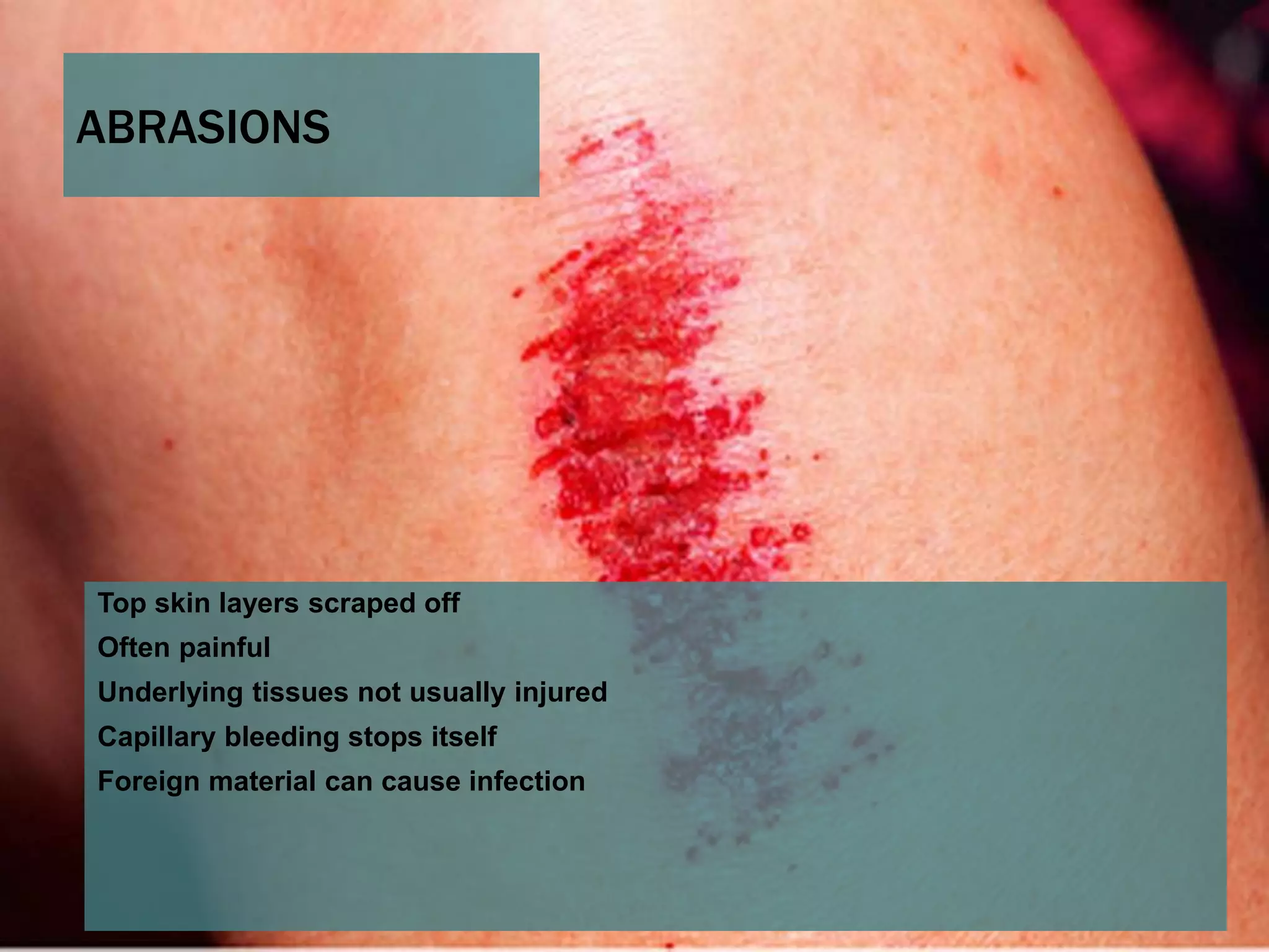 13 soft tissue_injuries | PPT