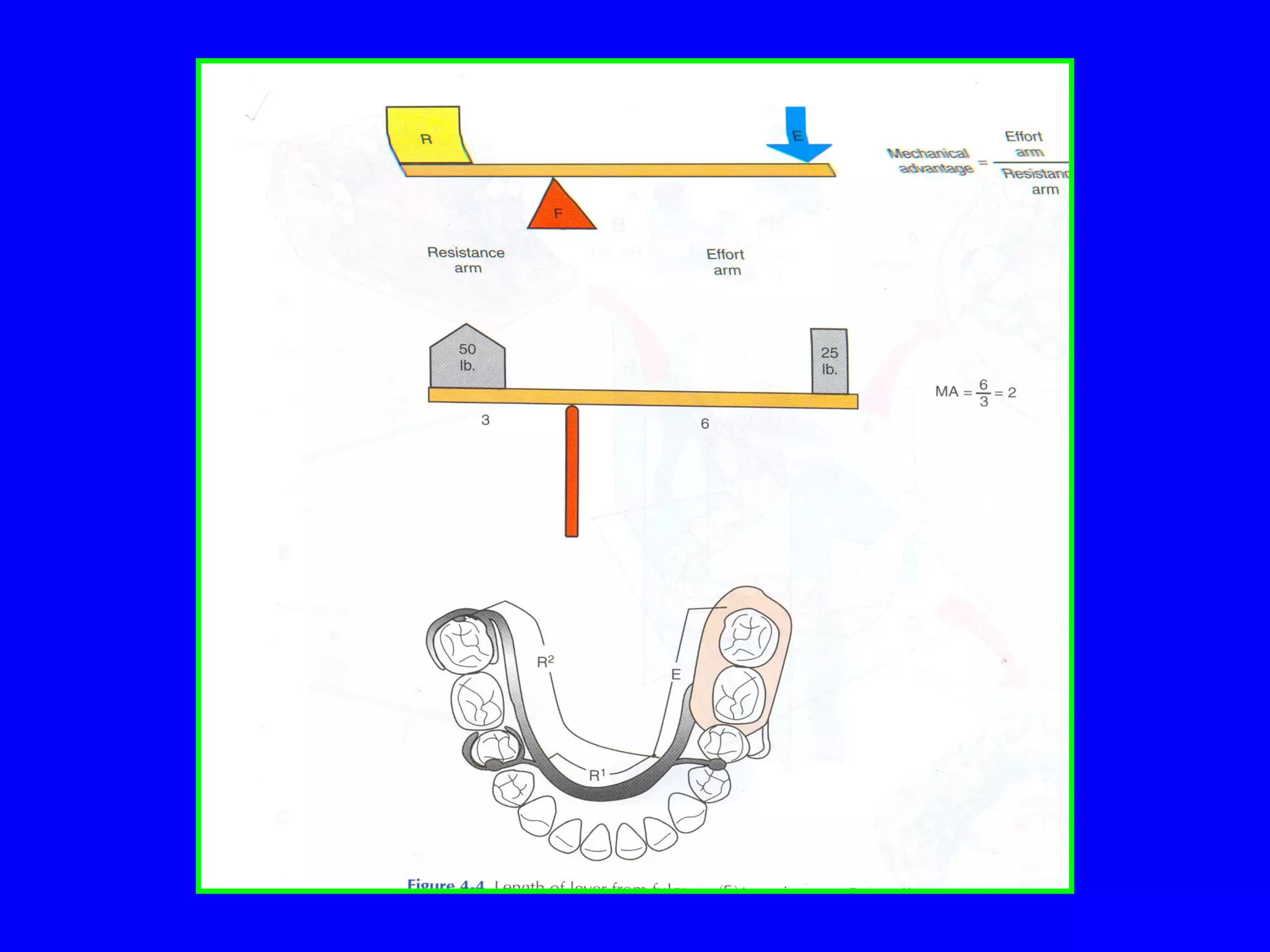 support for distal extension partial denture | PPT