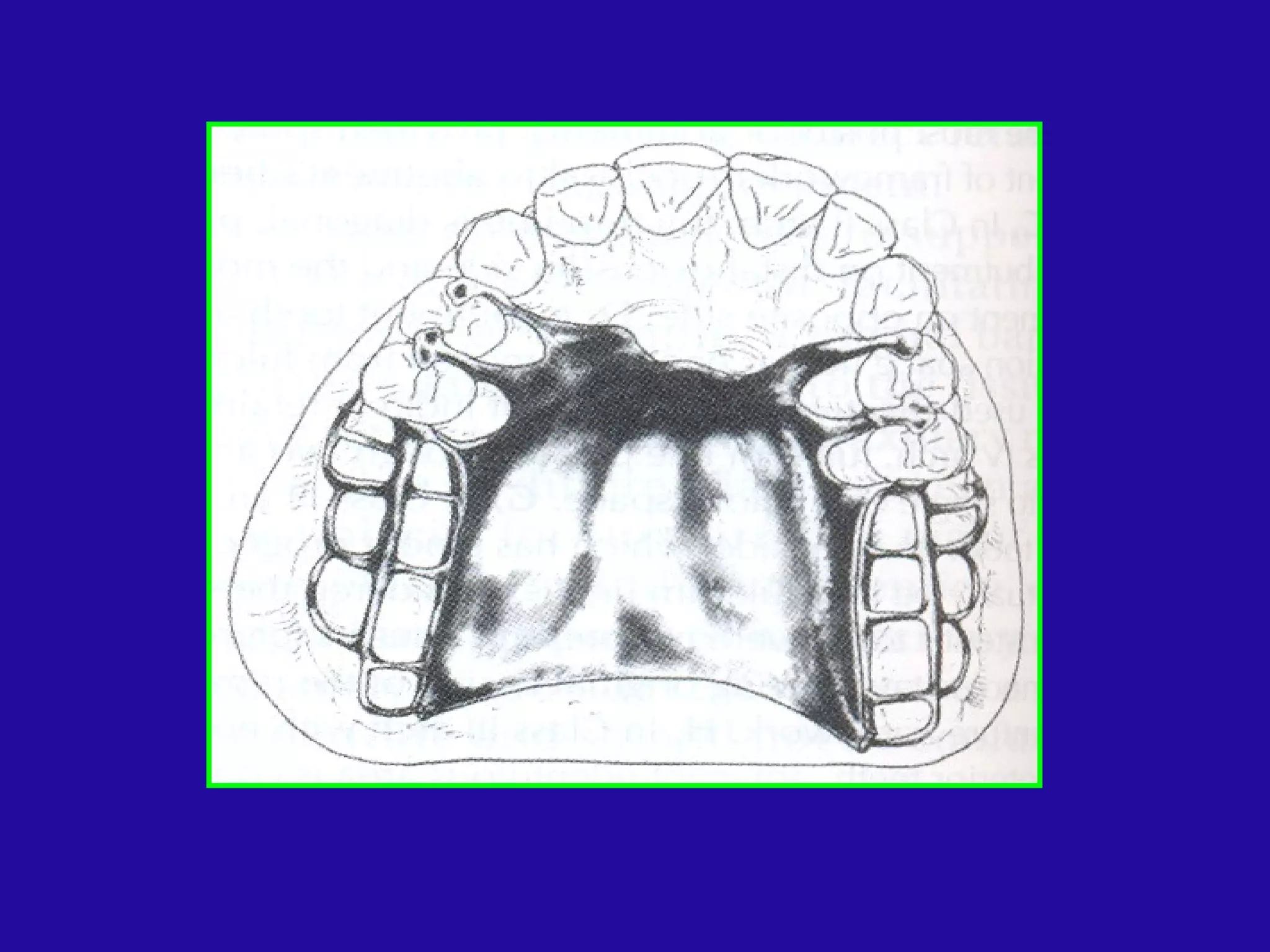 support for distal extension partial denture | PPT