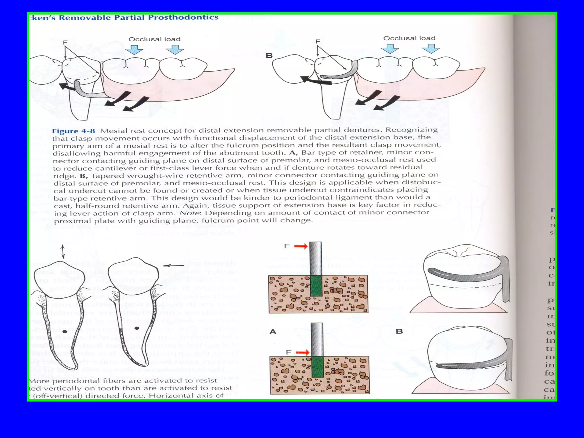 support for distal extension partial denture | PPT