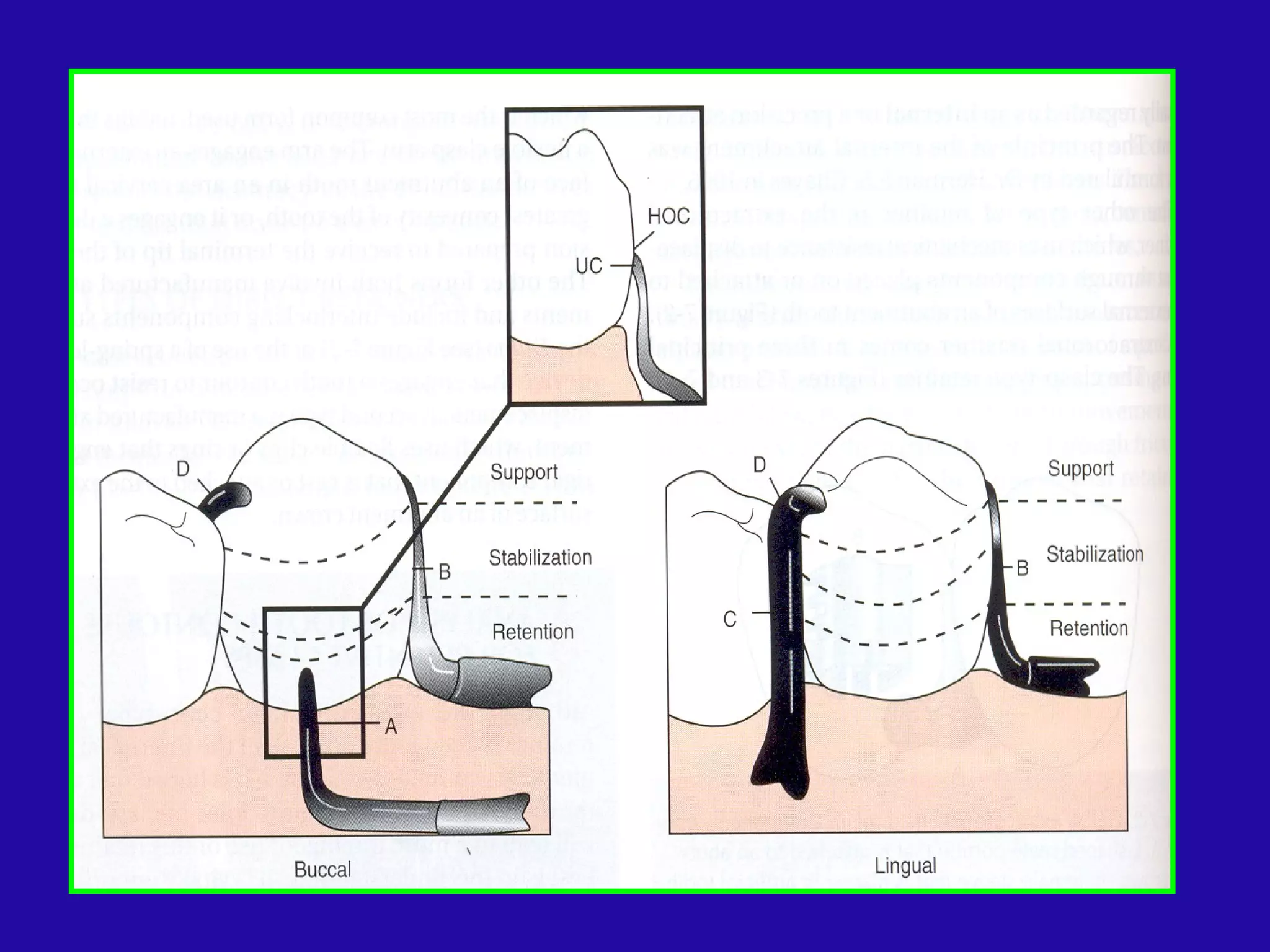 support for distal extension partial denture | PPT