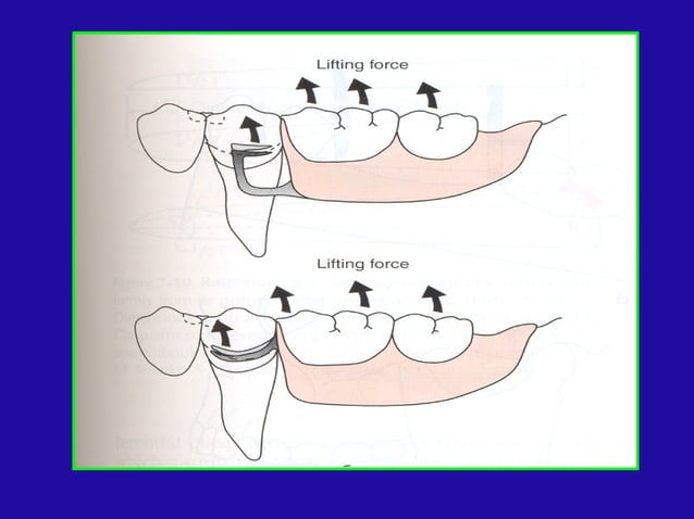support for distal extension partial denture | PPT | Dental Health ...