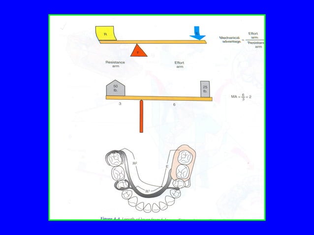 support for distal extension partial denture | PPT | Dental Health ...