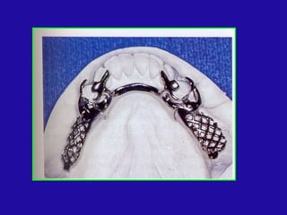 support for distal extension partial denture | PPT | Dental Health ...