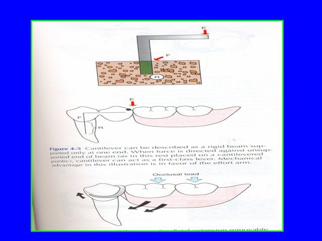 support for distal extension partial denture | PPT | Dental Health ...