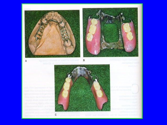 support for distal extension partial denture | PPT | Dental Health ...