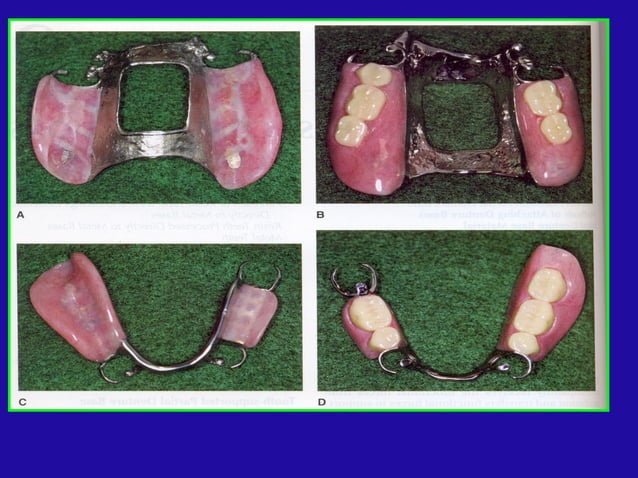 support for distal extension partial denture | PPT | Dental Health ...