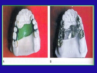 support for distal extension partial denture | PPT | Dental Health ...