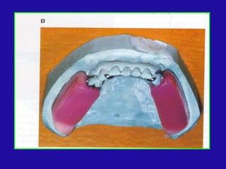support for distal extension partial denture | PPT | Dental Health ...