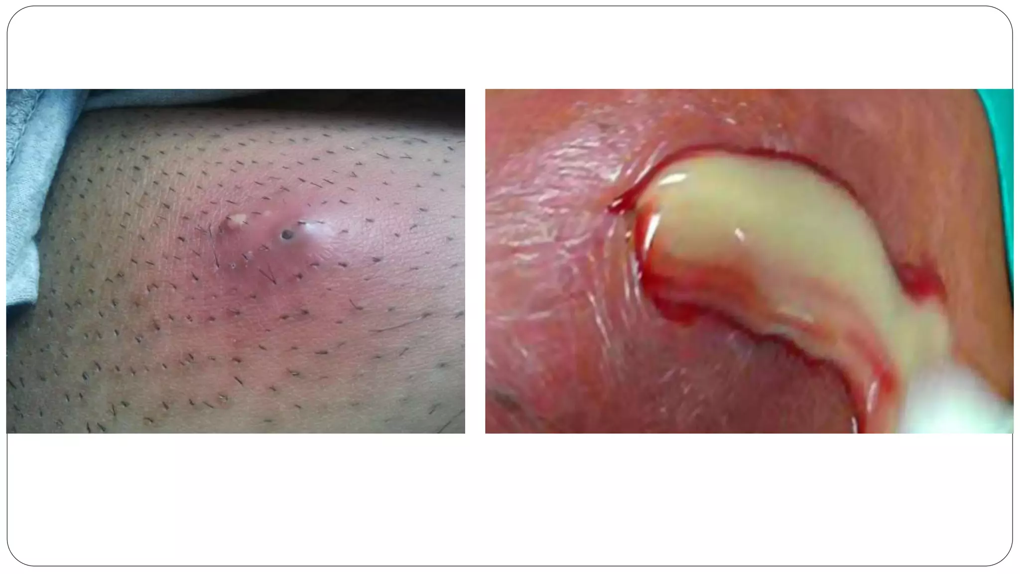 13 Surgical Infections of the Skin and Subcutaneous Tissues.pptx
