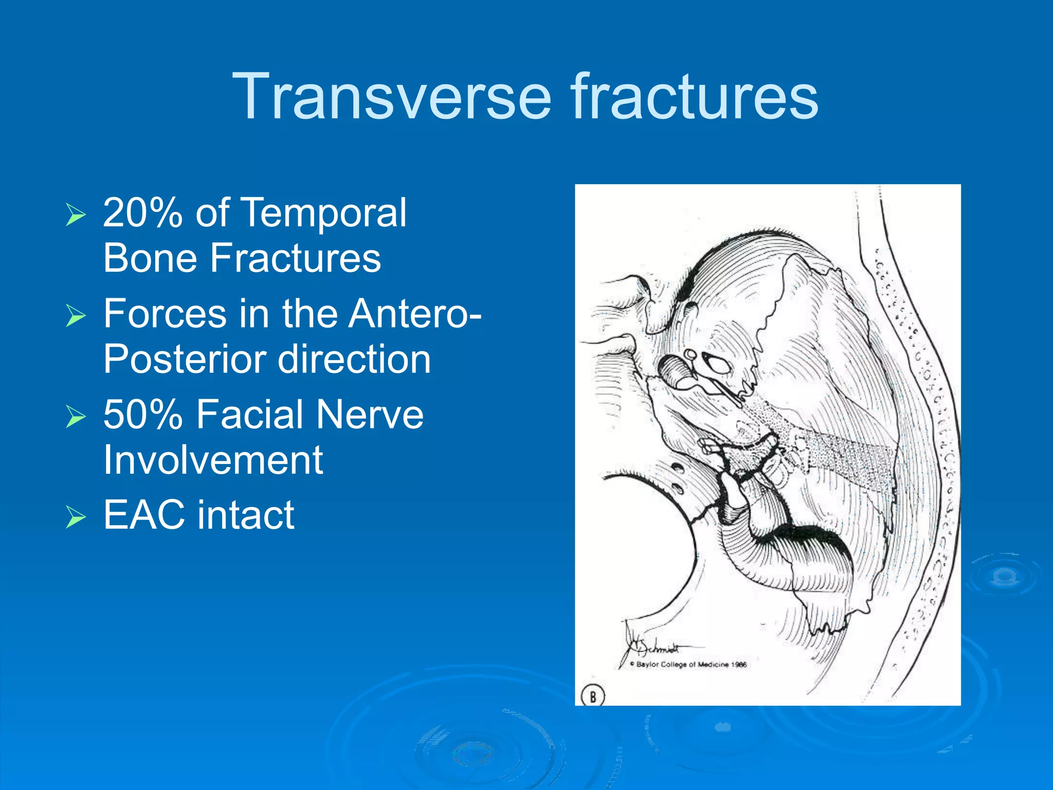 13temporalbonetrauma-100415230612-phpapp01-5(1).pptx