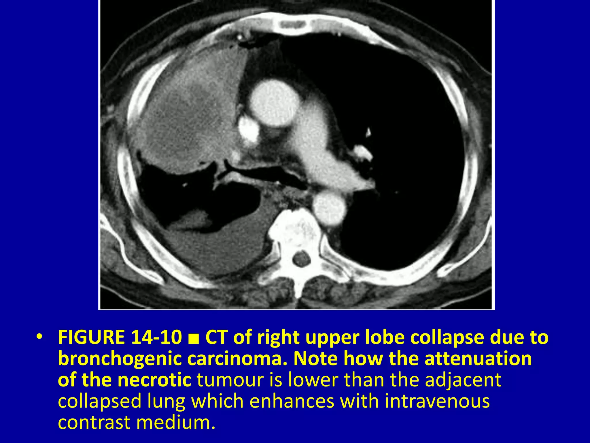 Pulmonary Lobar Collapse: Essential Considerations 14 Dr. Muhammad Bin ...