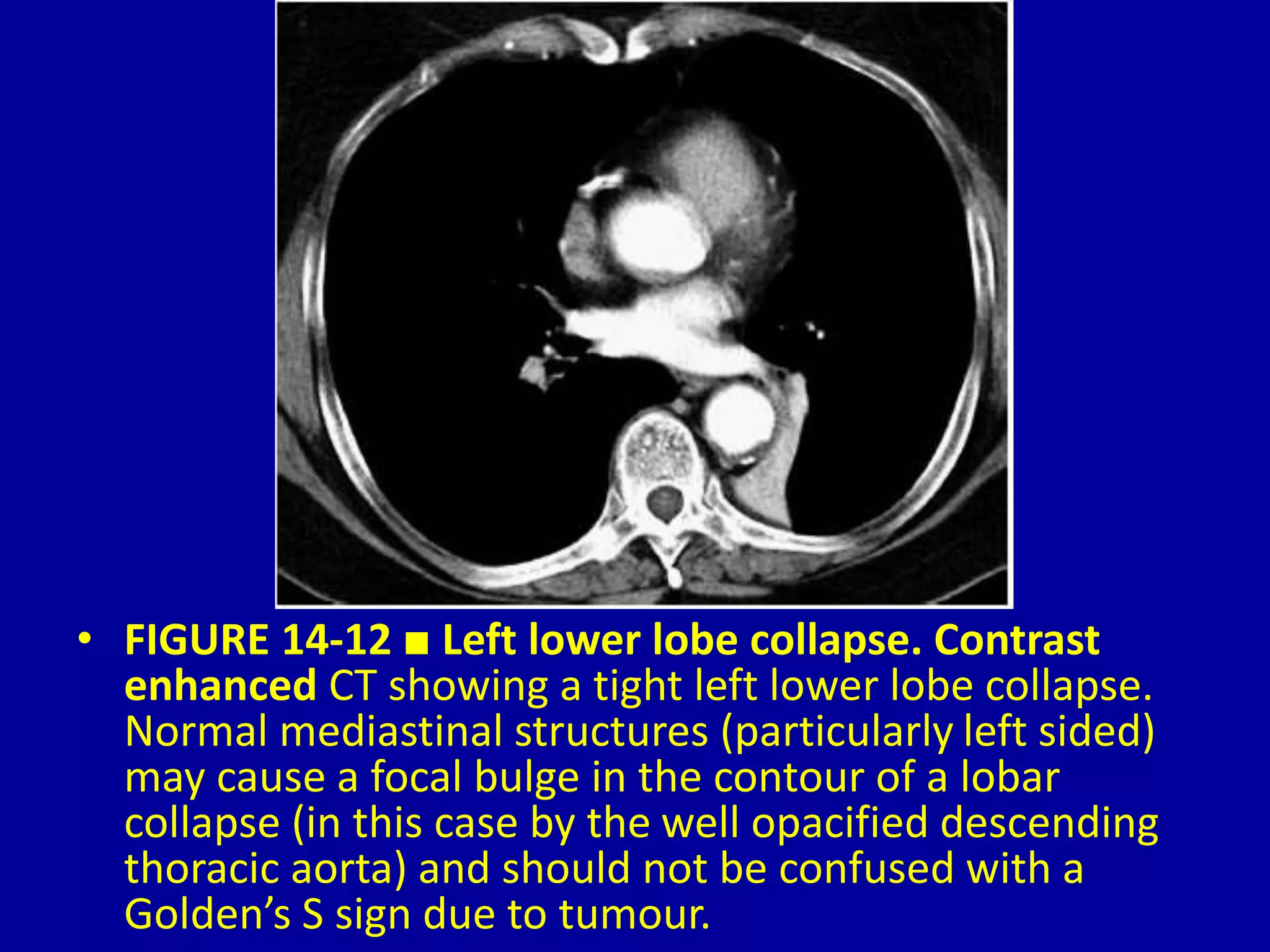 Pulmonary Lobar Collapse: Essential Considerations 14 Dr. Muhammad Bin ...