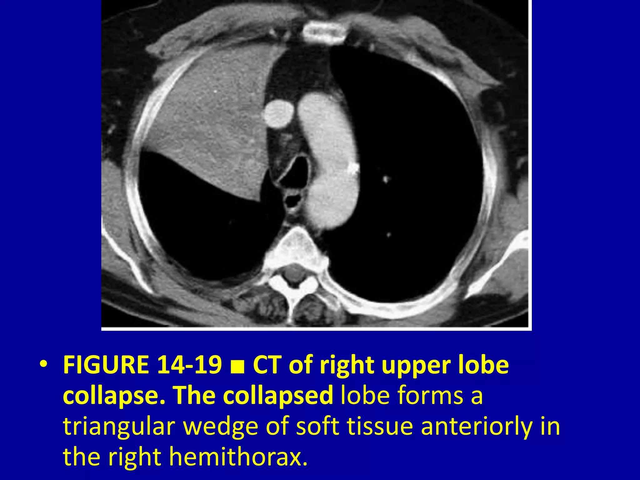 Pulmonary Lobar Collapse: Essential Considerations 14 Dr. Muhammad Bin ...