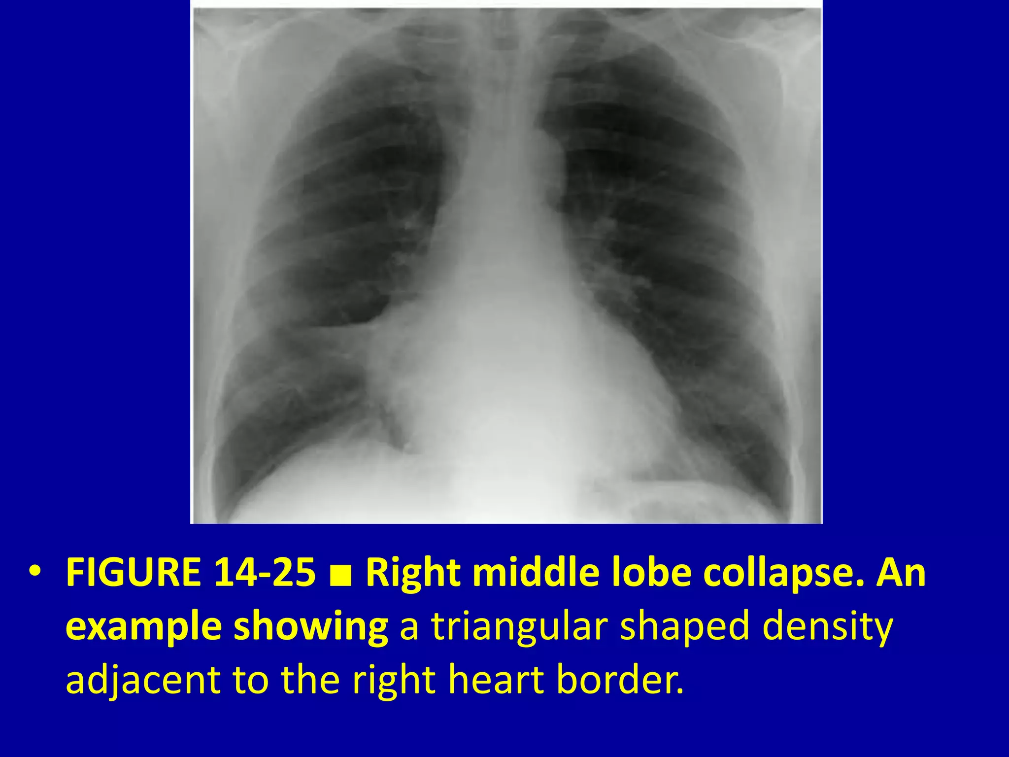 Pulmonary Lobar Collapse: Essential Considerations 14 Dr. Muhammad Bin ...