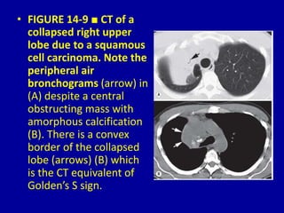 Pulmonary Lobar Collapse: Essential Considerations 14 Dr. Muhammad Bin ...